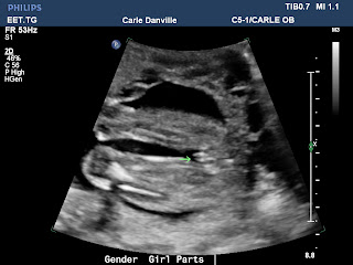 Turtle Sign Ultrasound