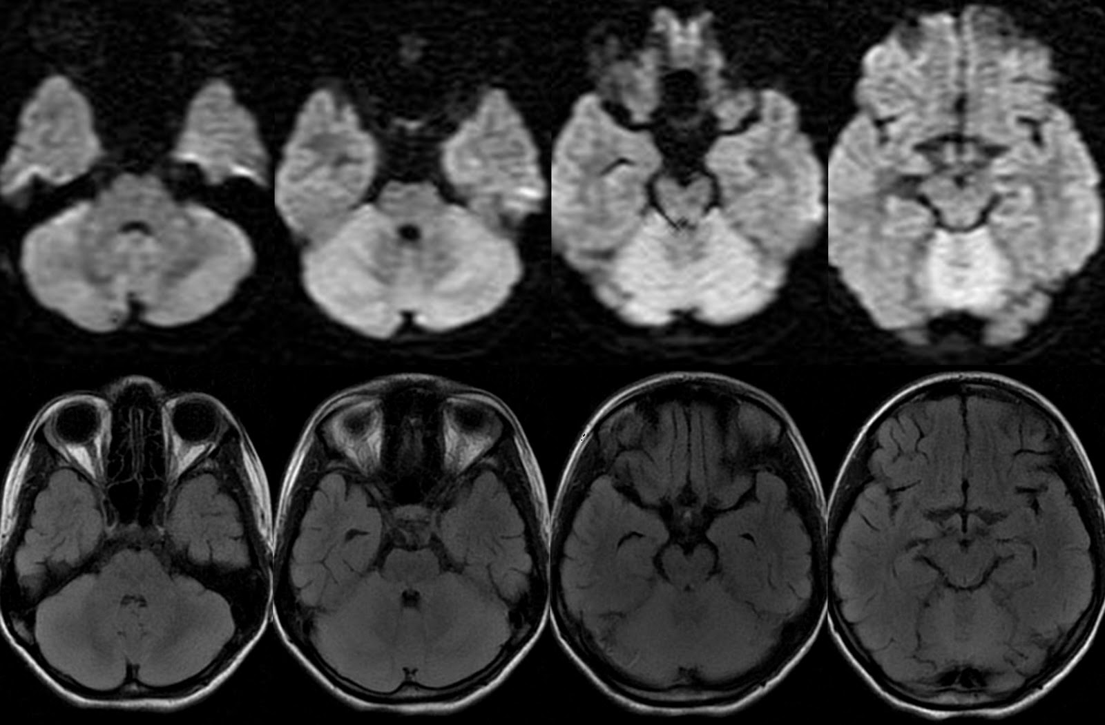 Dr Balaji Anvekar FRCR: Role of MRI Diffusion