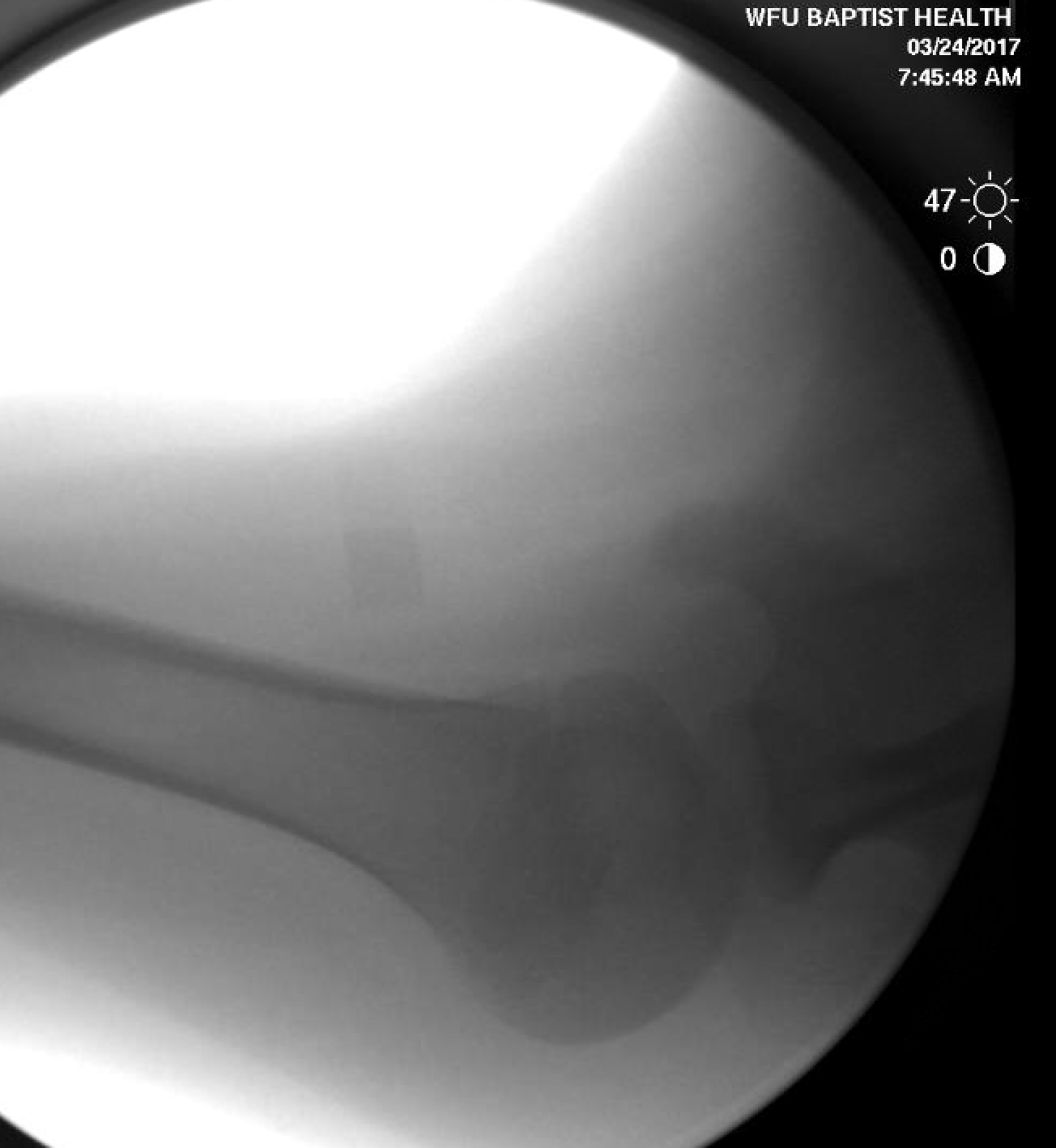 Shoulder and Elbow Surgery: Posterior chondrolabral cleft and recurrent ...