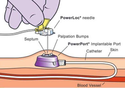 Cateter totalmente implantado ou Port-a-cath® | Enfermagem