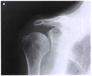 POSTERIOR OBLIQUE POSITION - GLENOID CAVITY: SHOULDER (NONTRAUMA ...