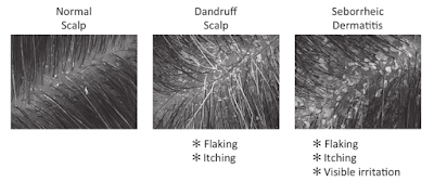 ASK DIS: Management of dandruff