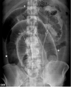 Tecnicos Radiologos: Signo Radiológico de Rigler, o de 'Doble pared' en ...