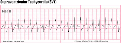 ECG Educator Blog : Supraventricular Tachycardia (SVT)
