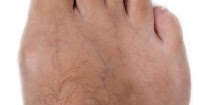 MedFriendly Medical Blog: Essential Reference Guide to Overlapping Toes