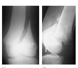 Distal Femoral Epiphysiolysis