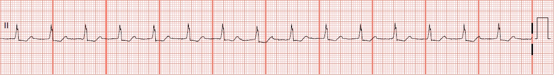 EKG Rhythm Strips: Hyperkalemia part 2