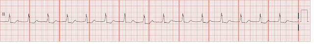 EKG Rhythm Strips: Hyperkalemia part 2