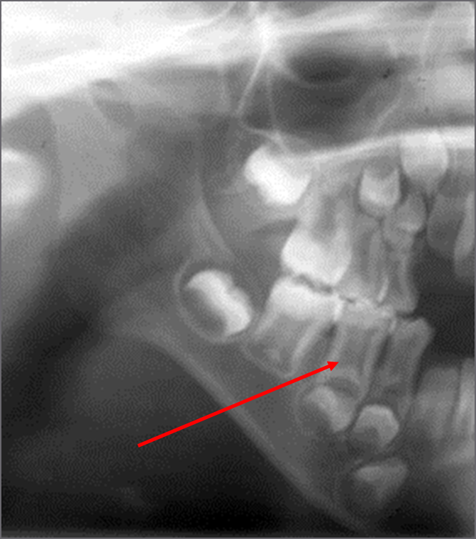 Radiología oral y maxilofacial: Interpretación de patologías pulpares y ...