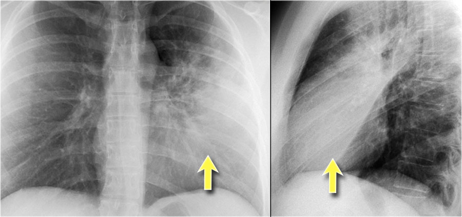 ¿Sabemos leer una RX de tórax? Parte 2: Principales signos radiológicos.