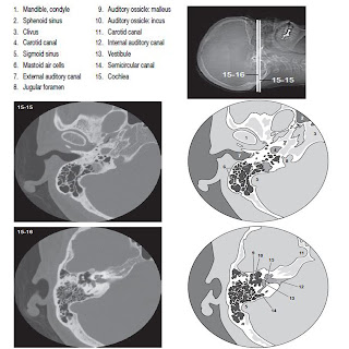 Temporal Bone - CT Scan - RadTechOnDuty
