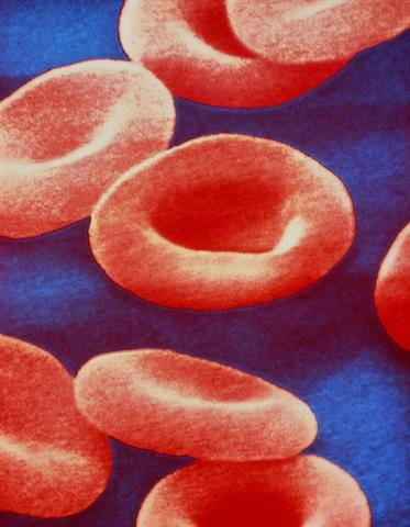 Conheça os 4 tipos de Leucemia e sintomas. « Bibi Mel Dicas