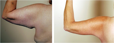 Plastic Surgery Before And After: Arm Lift
