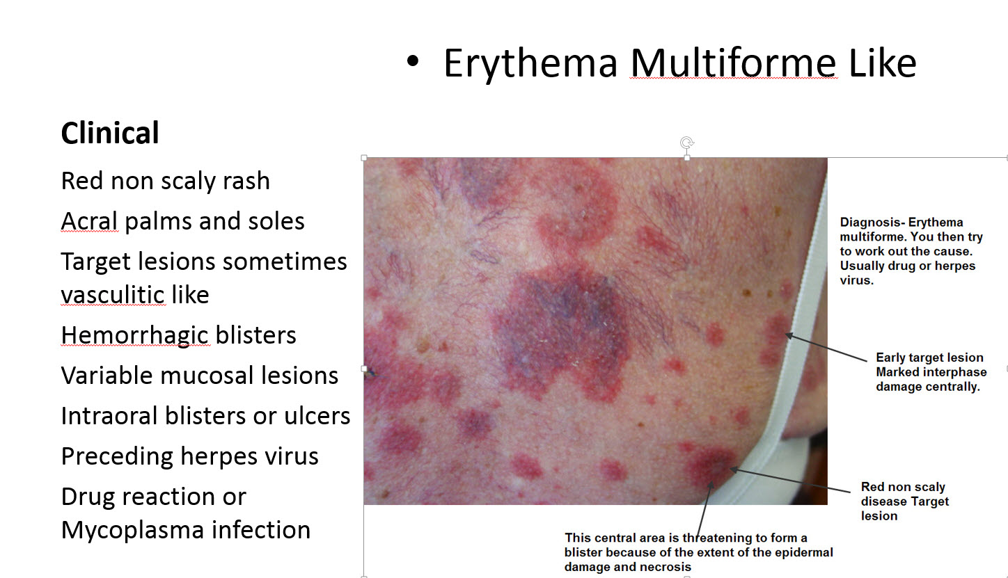 Dermatopathology Made Simple - Inflammatory: Interface - Vacuolar ...