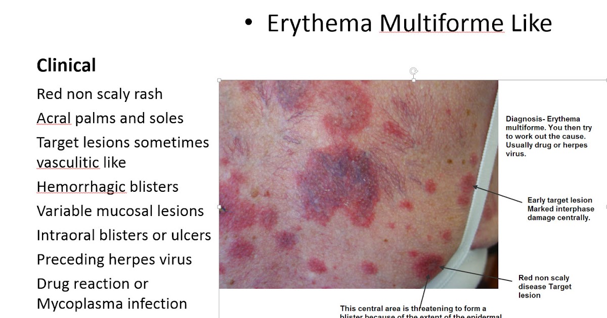 Dermatopathology Made Simple - Inflammatory: Interface - Vacuolar ...
