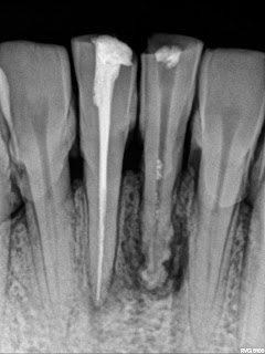 Endodontics: External root resorption with lower anterior teeth due to ...