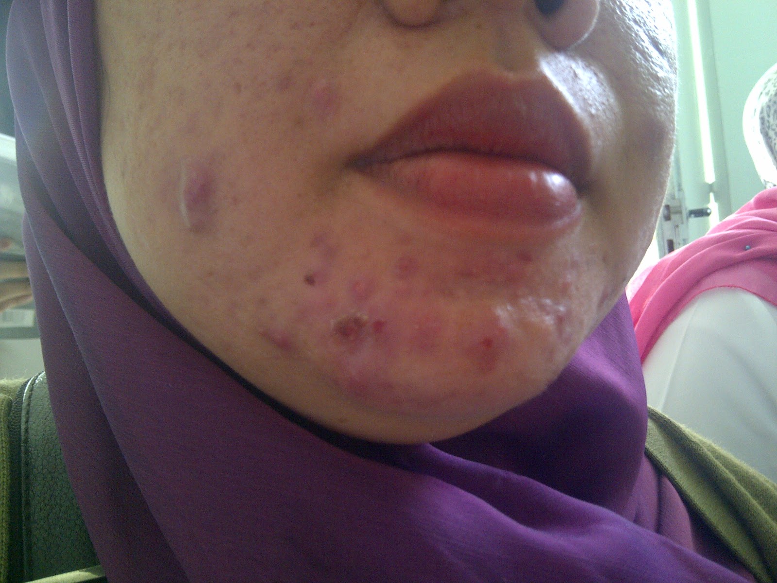 ChyntiaBlog: Laporan Kasus AKNE VULGARIS