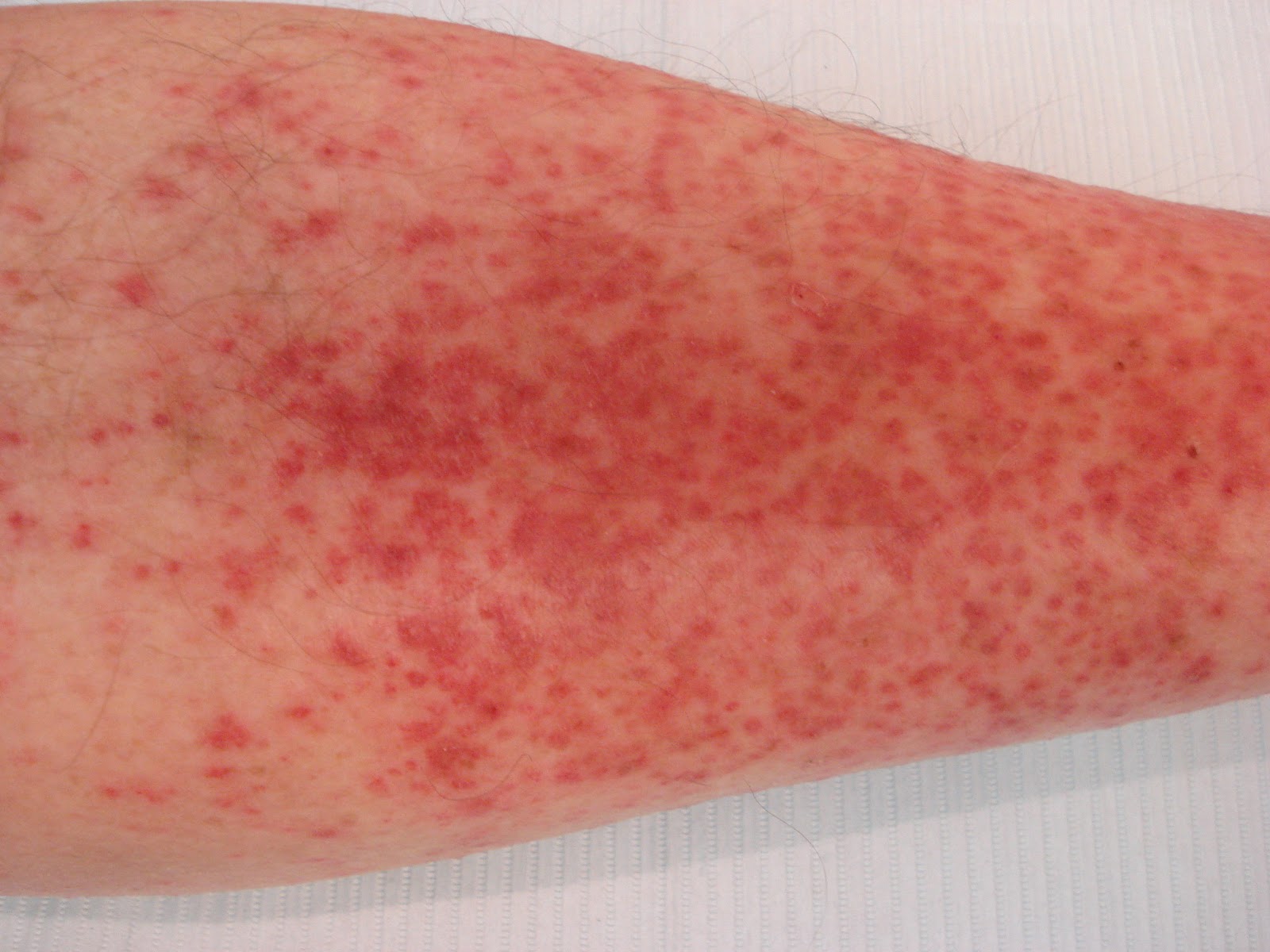 VIRTUAL GRAND ROUNDS IN DERMATOLOGY 2.0: PVLE Variant?