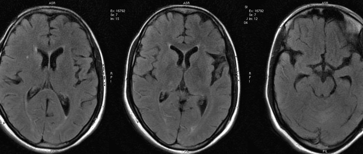 Dr Balaji Anvekar FRCR: Vasculitis Induced Infarct MRI