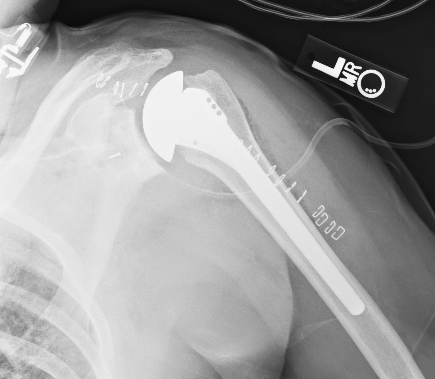 Shoulder and Elbow Surgery: How to ream a biconcave glenoid and when to ...