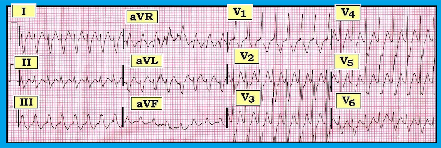 ECG Interpretation: ECG Blog #135 (Regular WCT – Fascicular VT – RBBB ...