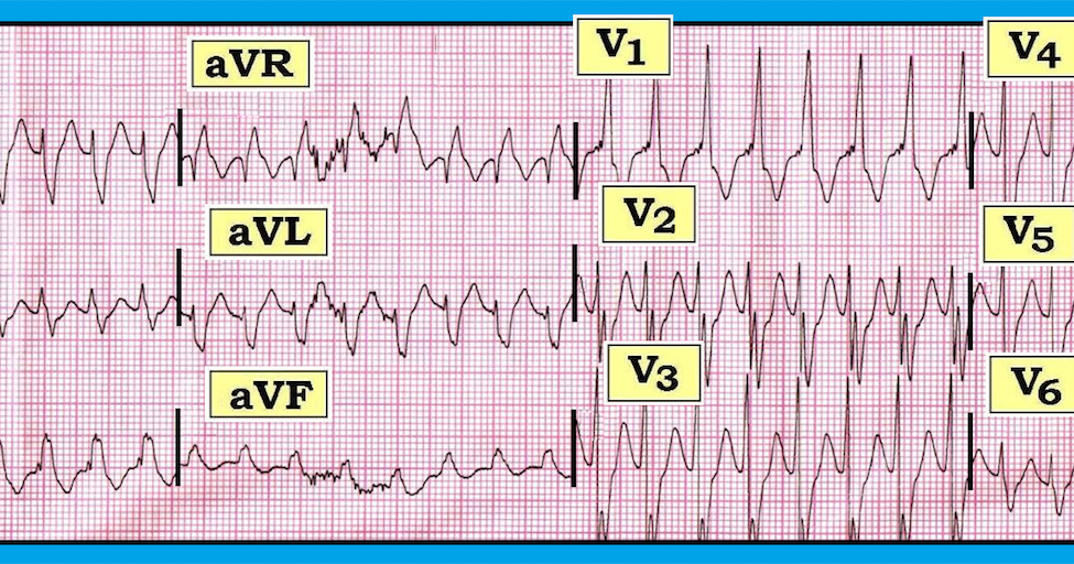 ECG Interpretation: ECG Blog #135 (Regular WCT – Fascicular VT – RBBB ...