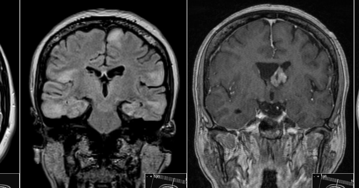 Radiology MRI: Tuberous Sclerosis