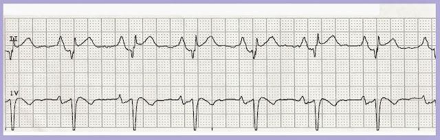 Practice EKG Rhythm Strips 233