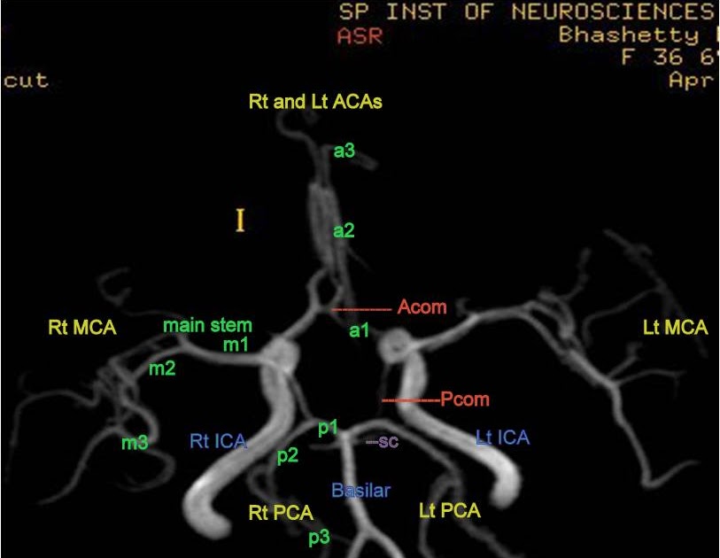 Dr Balaji Anvekar FRCR: Vascular territory of brain