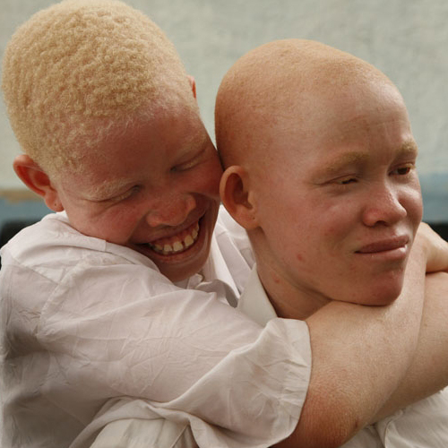 ALBINOS IN AFRICA