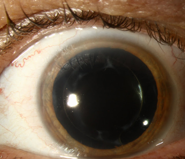 Cataract, It's causes, treatment and Cataract Surgery - Eye Health Nepal