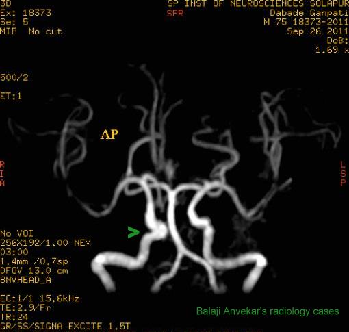 Dr Balaji Anvekar's Neuroradiology Cases: Intracavernous ICA Curvature
