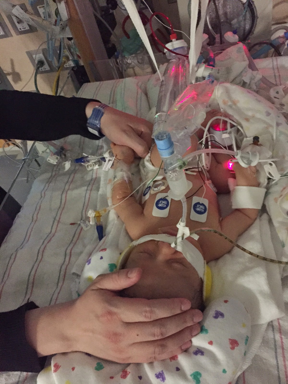 Vivienne's CDH Story: Day 7: Baby Steps and Special Moments