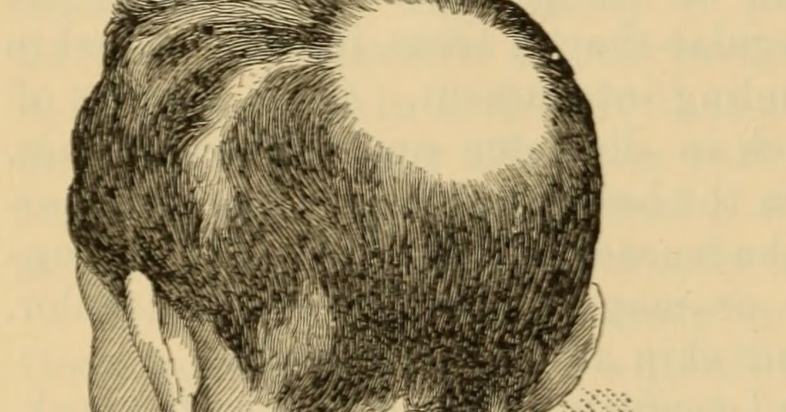 Best Treatment For Folliculitis: Similarities and Differences Between ...