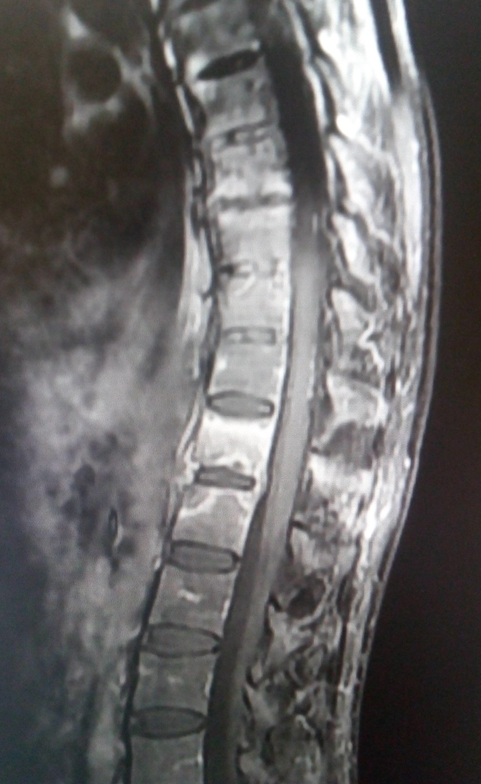 Ankylosing Spondylitis: MRI - Sumer's Radiology Blog