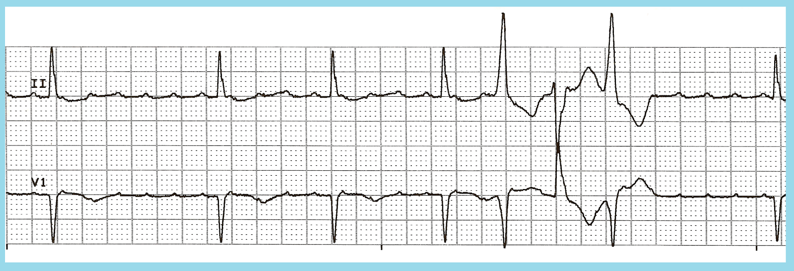 Atrial Dysrhythmia Quiz