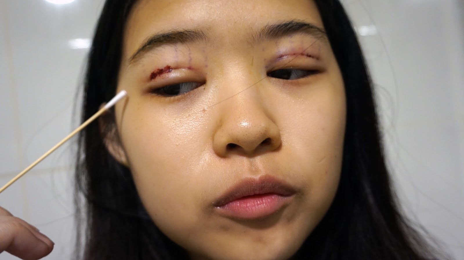 My double eyelid stitching - osmyuki