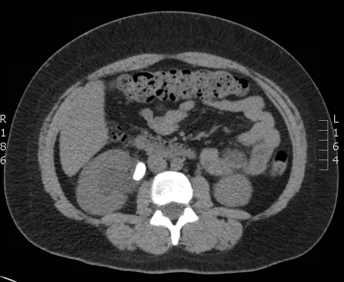 Emergency Medicine Visual Diagnosis: Diagnosis: Bilateral Nephrolithiasis