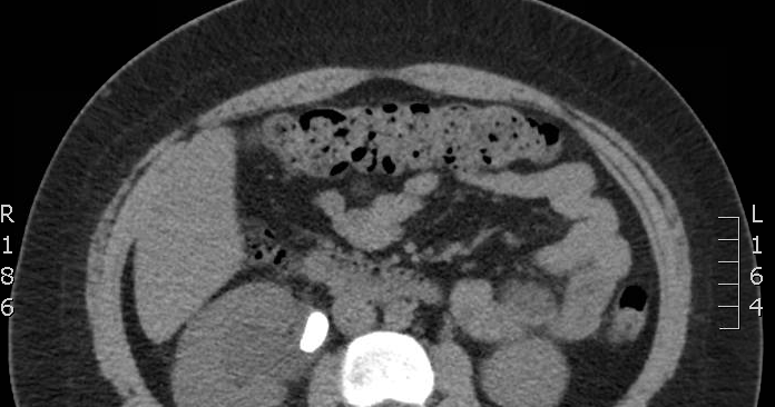 Emergency Medicine Visual Diagnosis: Diagnosis: Bilateral Nephrolithiasis