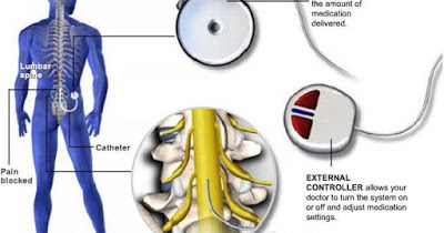 Advanced Pain Centers Pakistan: Intrathecal Pump Therapy