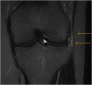 Iliotibial Band Friction Syndrome-MRI - Sumer's Radiology Blog