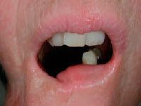 DENTISTRY: MICROSTOMIA