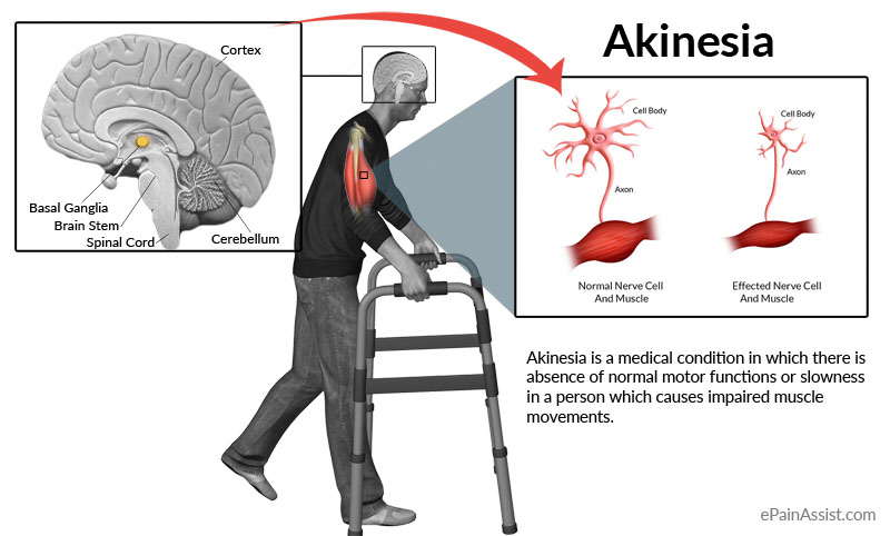 Our Parkinson's Place: All you need to know about akinesia