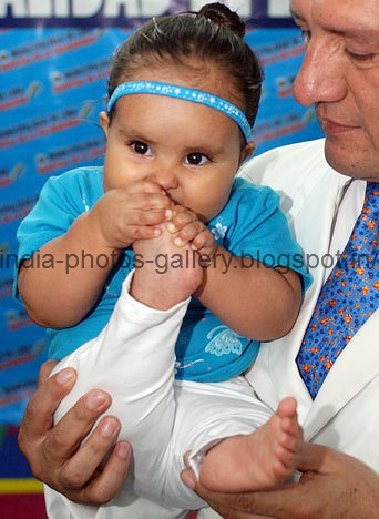 INDIA PHOTO GALLERY: Extremely rare birth defects
