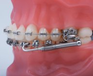 Clínica Odontológica Integral Xalapa: Forsus™ Fatigue Resistant Device