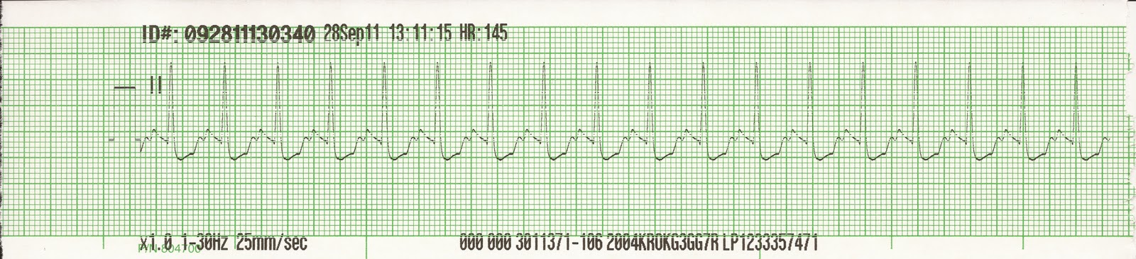 EKG Rhythm Strips 07