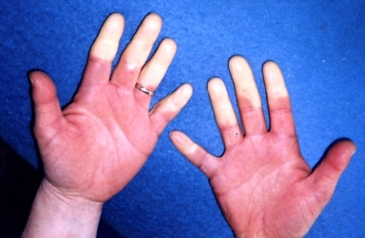 About Health: Raynaud’s syndrome
