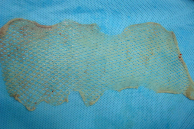 Curso de Cirugía Plástica CiruplasMedia: Injerto de Piel