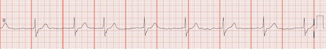 EKG Rhythm Strip Quiz 29