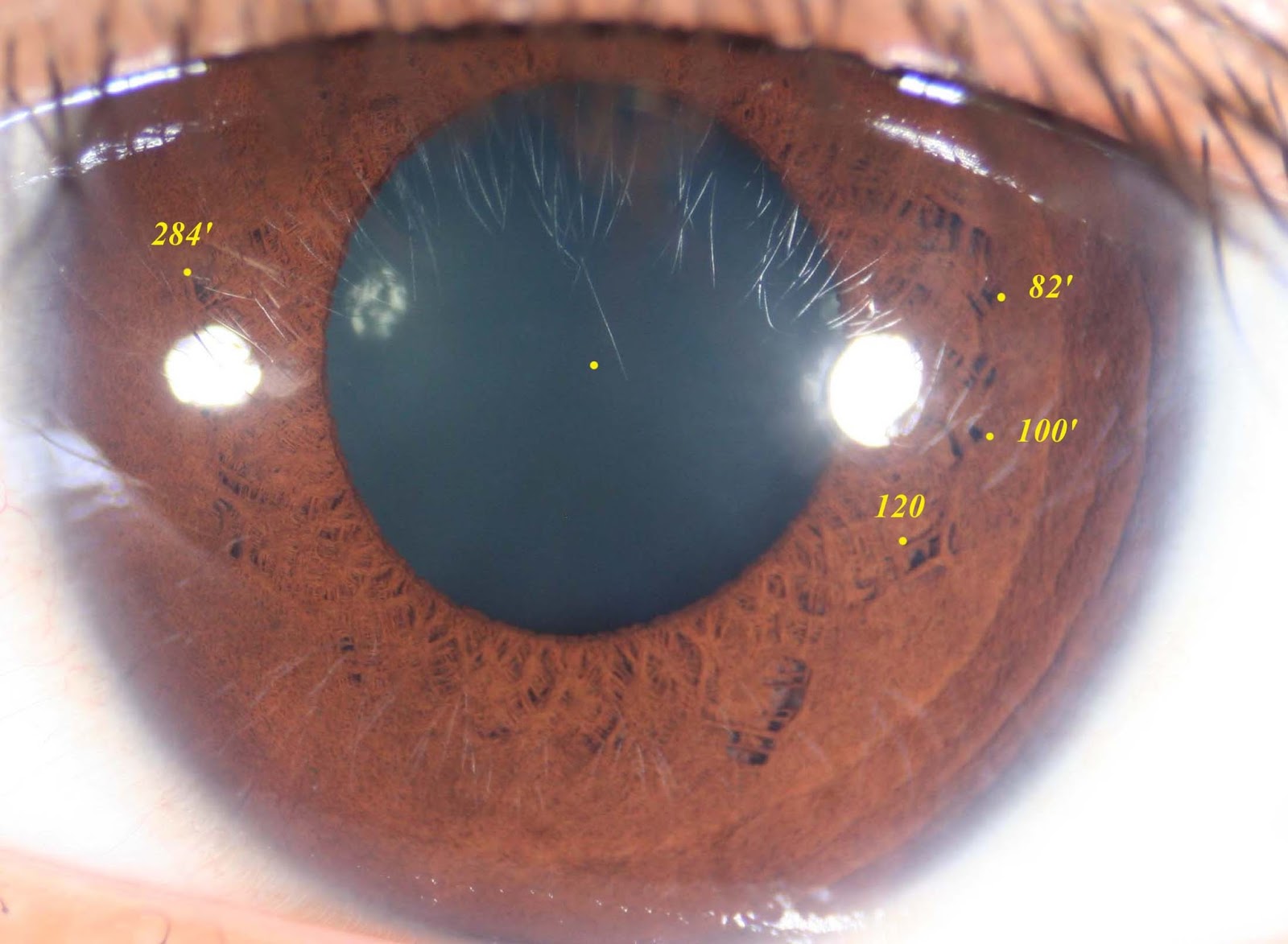 Modern & Multidimensional Iridology: Crypts at Pupillary Zone ...